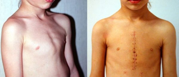 Surgery - Pectus Brace
