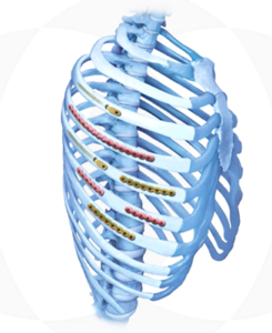 Rib Flare - Pectus Brace